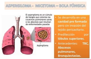MESOTELIOMA - ASPERGILOMA - HISTOPLASMOSIS PULMONAR | PDF