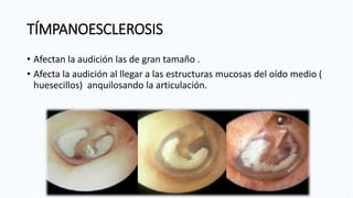 Seminario oido medio | PPT