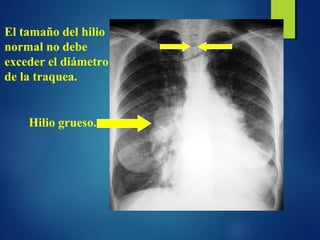 Opacidades pulmonares en Imagenología | PPT