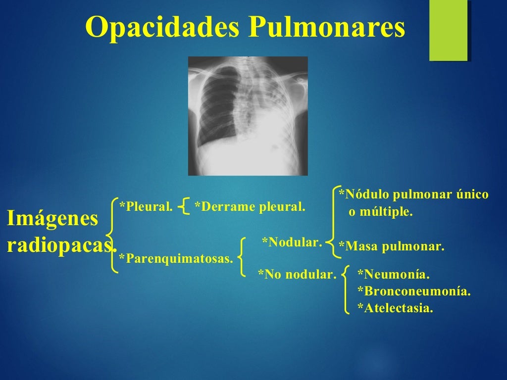 Opacidade Pulmonar é Cancer - RETOEDU