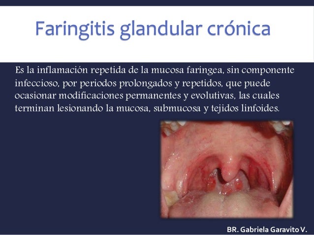 Seminario orofaringe .ppt