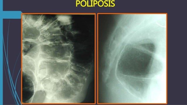 Las patologías del colon en Imagenología