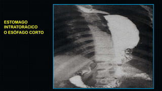 Patologías de esófago en Imagenología | PPTX
