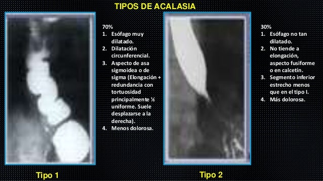 Patologías de esófago en Imagenología