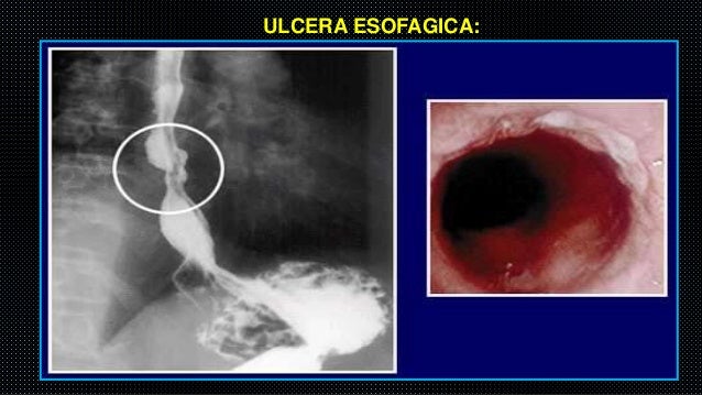 Patologías de esófago en Imagenología