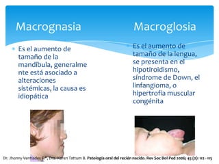 Patología oral del recién nacido, labio y paladar hendido | PPTX