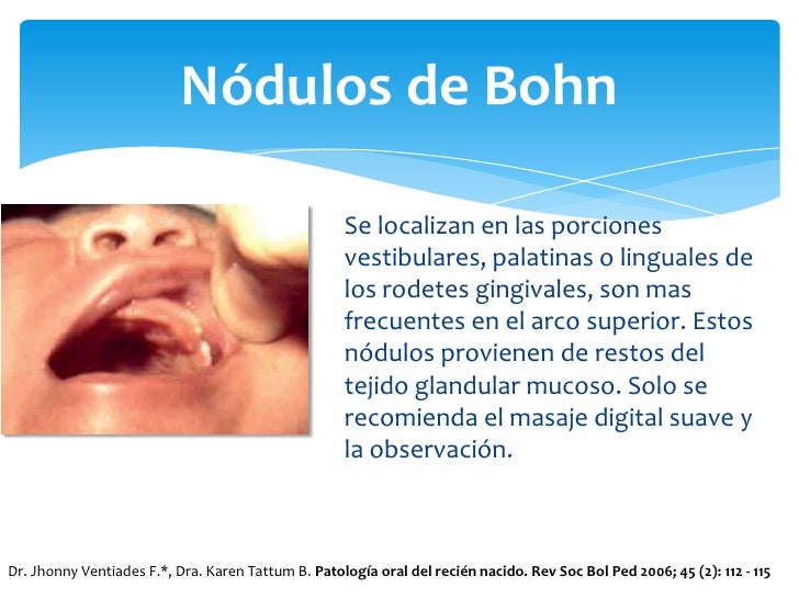 Patología oral del recién nacido, labio y paladar hendido