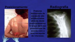 Seminário Ap e Perfil de Escápula | PPT