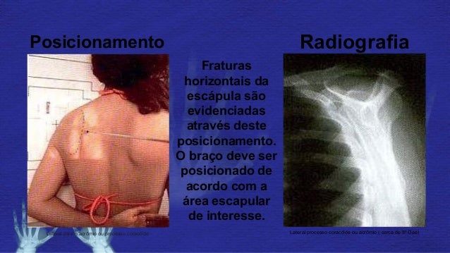 Seminário Ap e Perfil de Escápula