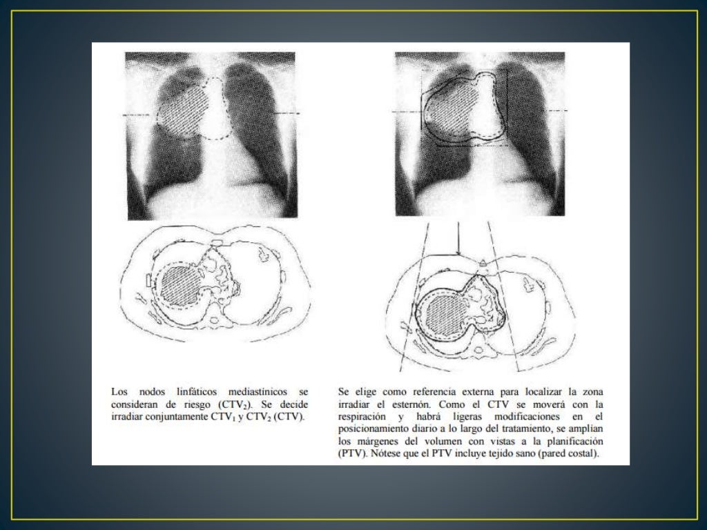Curvas de Isodosis (radioterapia)