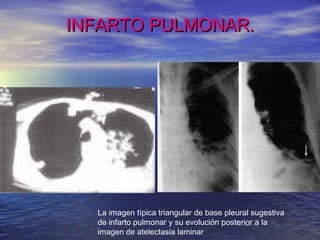 Radiología Pulmonar: Lesiones Consolidativas del Parénquima. | PPT