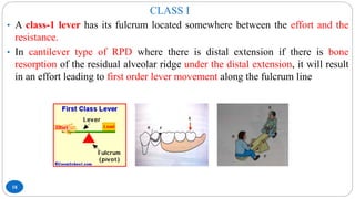 Management of Kennedys Class III Classification | PPTX