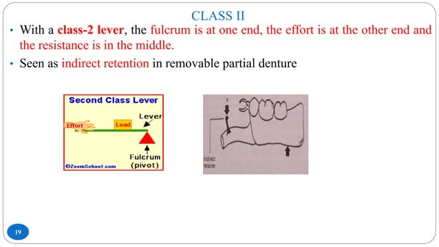 Management of Kennedys Class III Classification | PPTX