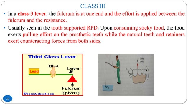 Management of Kennedys Class III Classification | PPTX