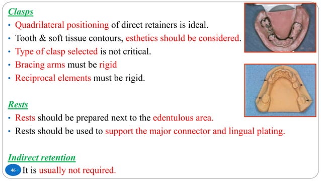 Management of Kennedys Class III Classification | PPTX