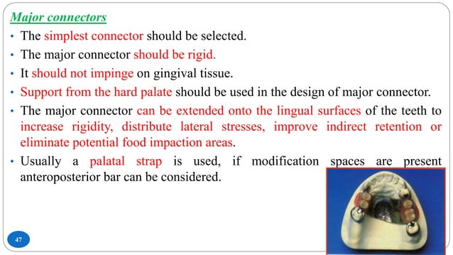 Management of Kennedys Class III Classification | PPTX