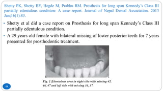 Management of Kennedys Class III Classification | PPTX