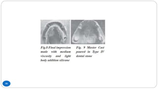 Management of Kennedys Class III Classification | PPTX