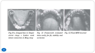 Management of Kennedys Class III Classification | PPTX