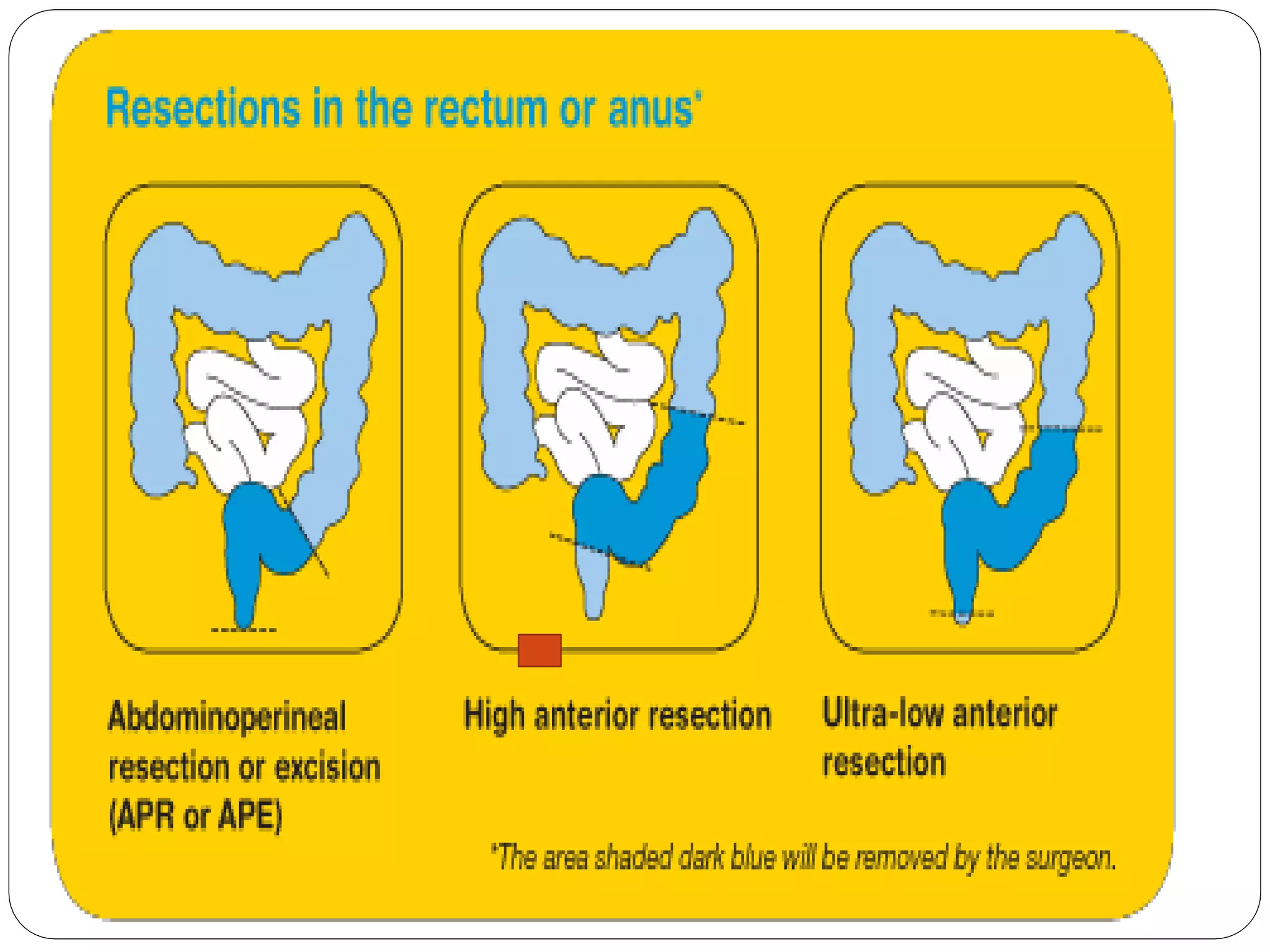 Management of Rectal Cancer | PPTX