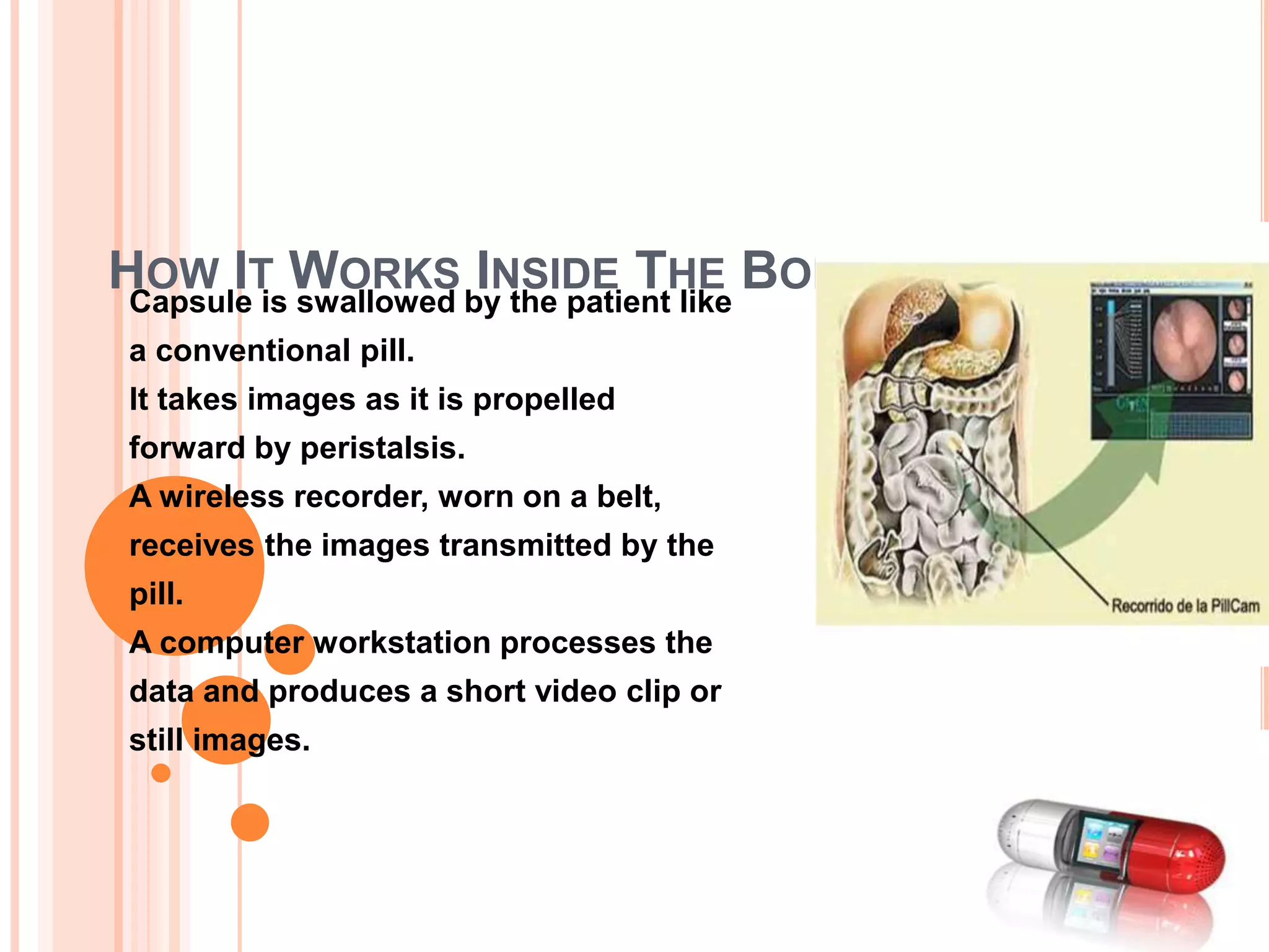 Seminar on microelectronic pill | PPTX