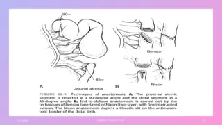 SEMINAR neonate INTESTINal obstruction highlighting duodenal atresia ...