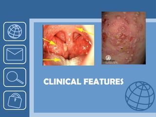 Acute Poststreptococcal Glomerulonephritis | PPTX