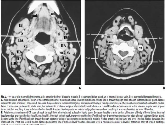 Differential Diagnosis of Lymphadenopathy | PPTX | Ear, Nose and Throat ...
