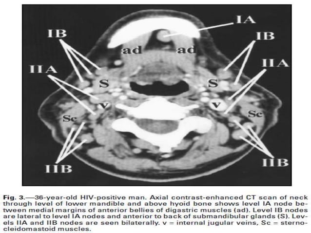 Differential Diagnosis of Lymphadenopathy | PPTX | Ear, Nose and Throat ...