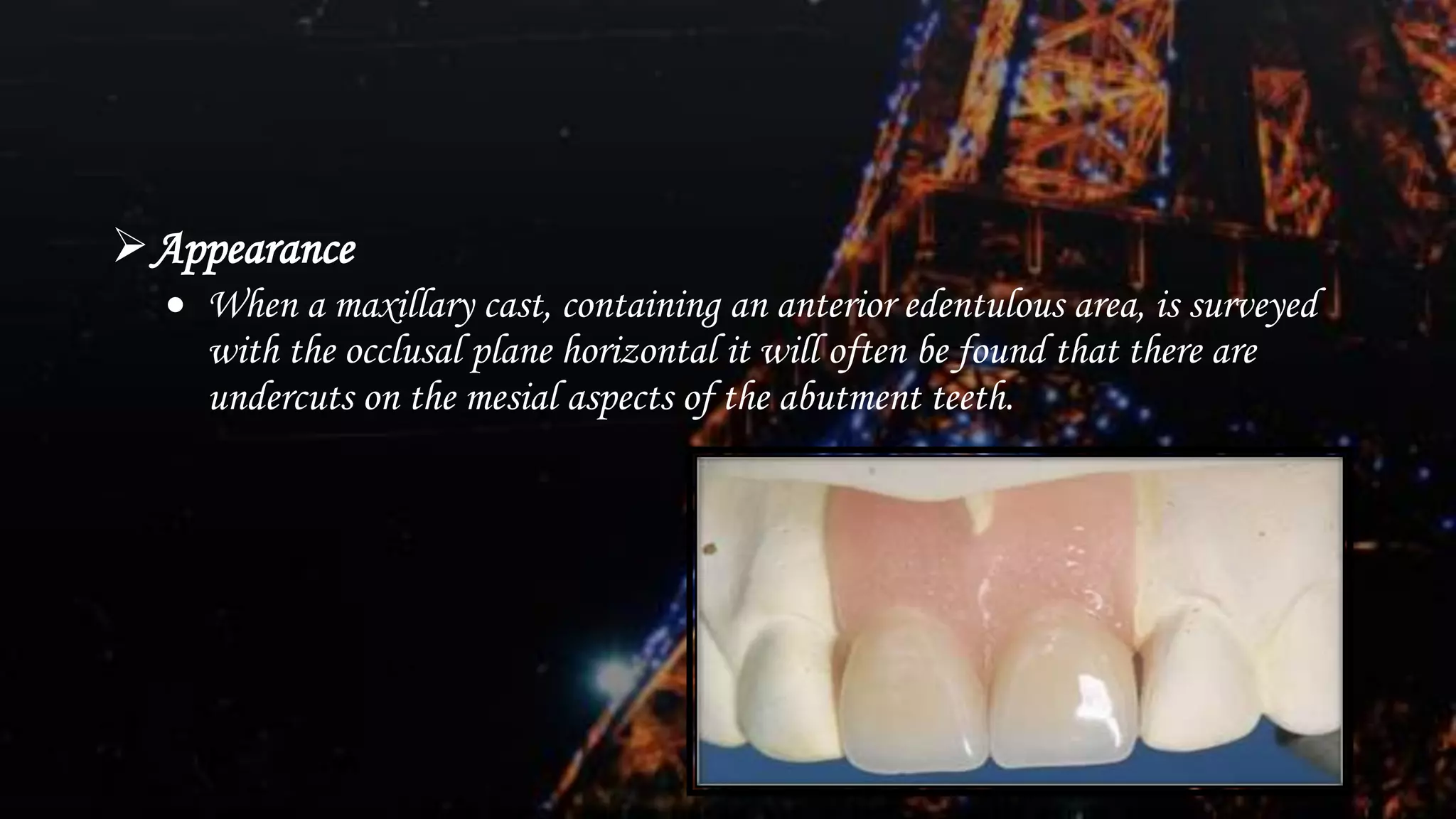 Dental surveying of Removal partial denture | PDF
