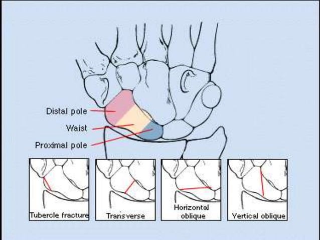 scaphoid and lunate fractures