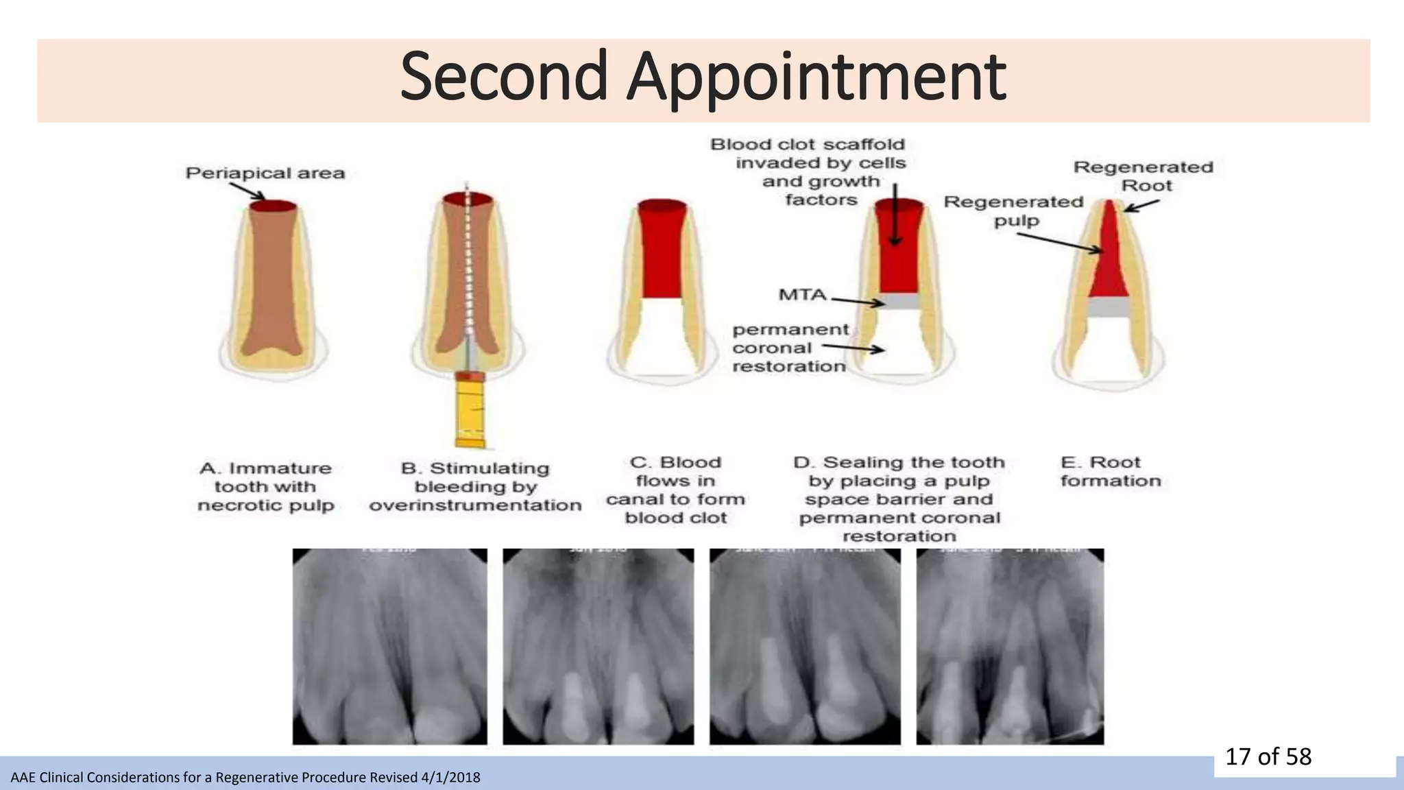 Regenerative Endodontics | PPTX