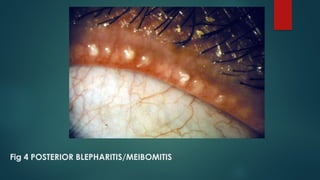 SEMINAR ON BLEPHARITIS/:MEIBOMITIS.pptx doc | PPTX