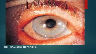 SEMINAR ON BLEPHARITIS/:MEIBOMITIS.pptx doc | PPTX