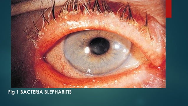 SEMINAR ON BLEPHARITIS/:MEIBOMITIS.pptx doc | PPTX