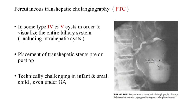 Seminar on choledochal cyst | PPTX | Digestive Disorders | Diseases and Conditions