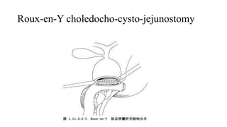 Seminar on choledochal cyst | PPTX
