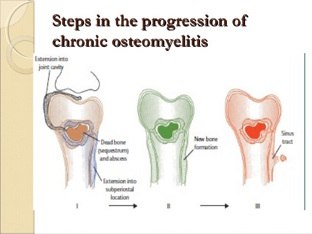 Seminar on chronic osteomyelitis sch