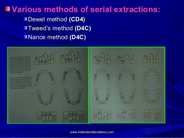 extraction in orthodontics