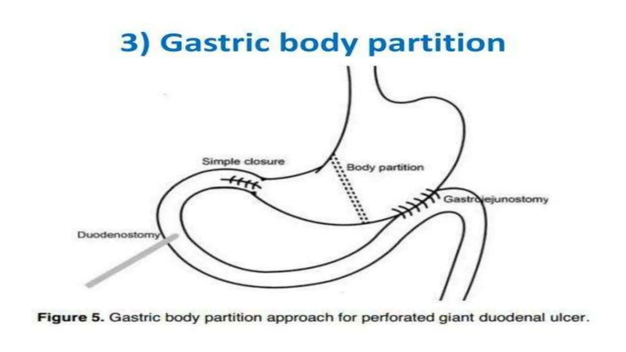 Seminar on gaint duodenal ulcer perforation -1.pptx