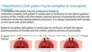 Seminar on Hard&Soft Palate anatomy.pptx