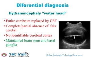 Seminar on hydrocephalus | PPTX