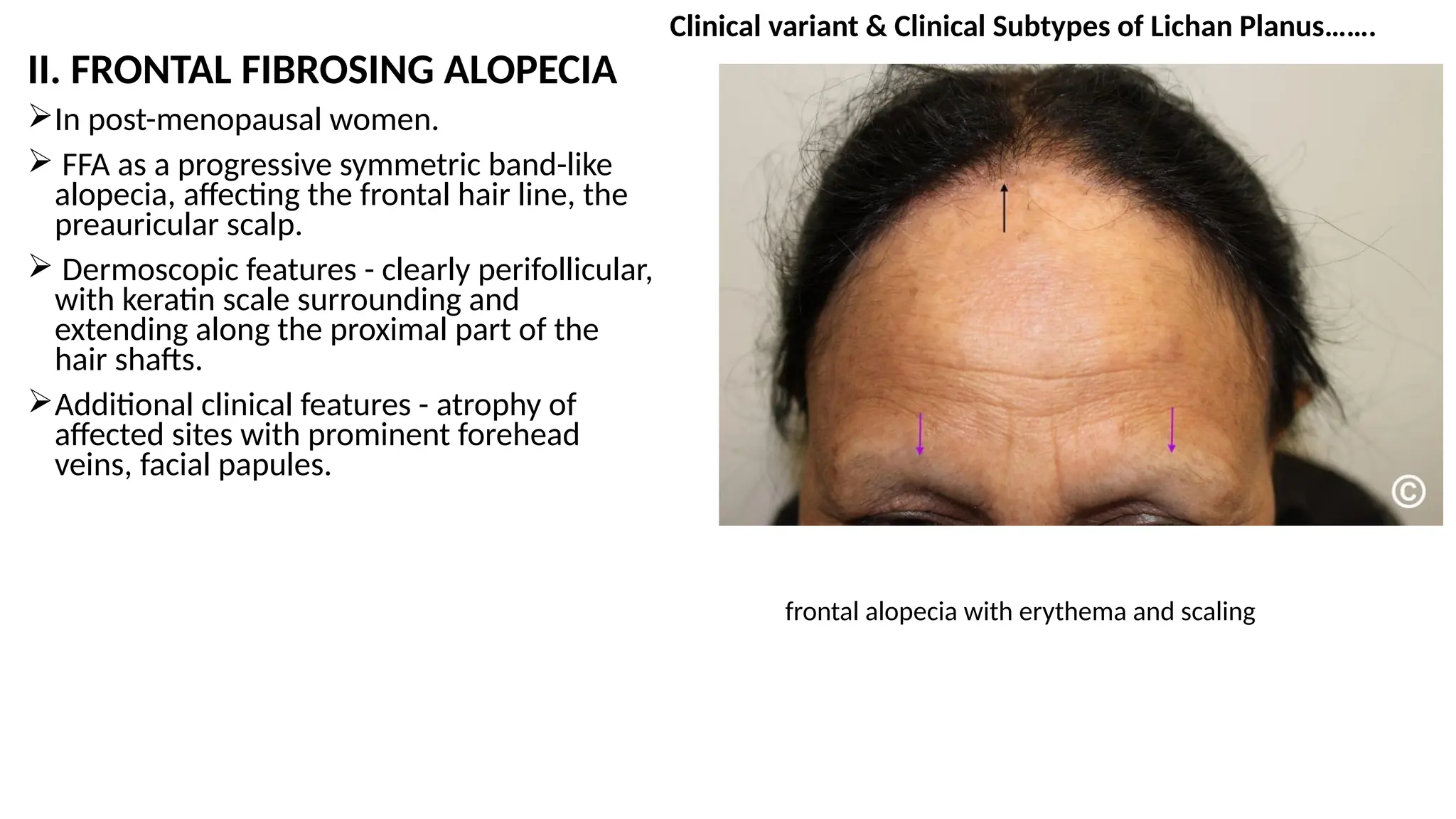 Seminar_on_Lichen_Planus Dr RAMAWATAR (2).pptx