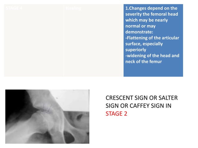 perthes disease | PPTX