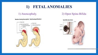 Polyhydramnios | PPTX