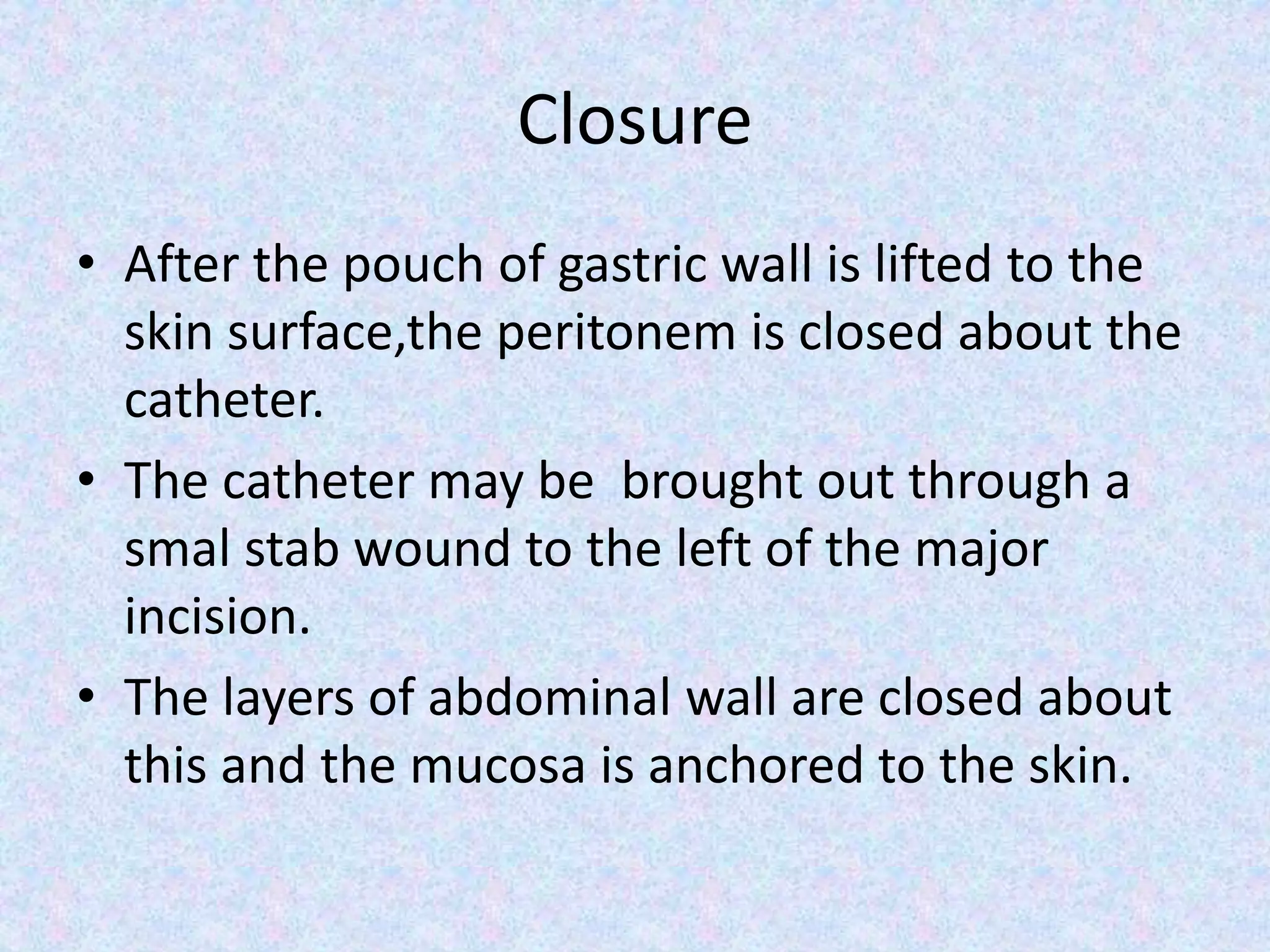 Seminar on stamm, janeway & PE gastrostomy | PPTX