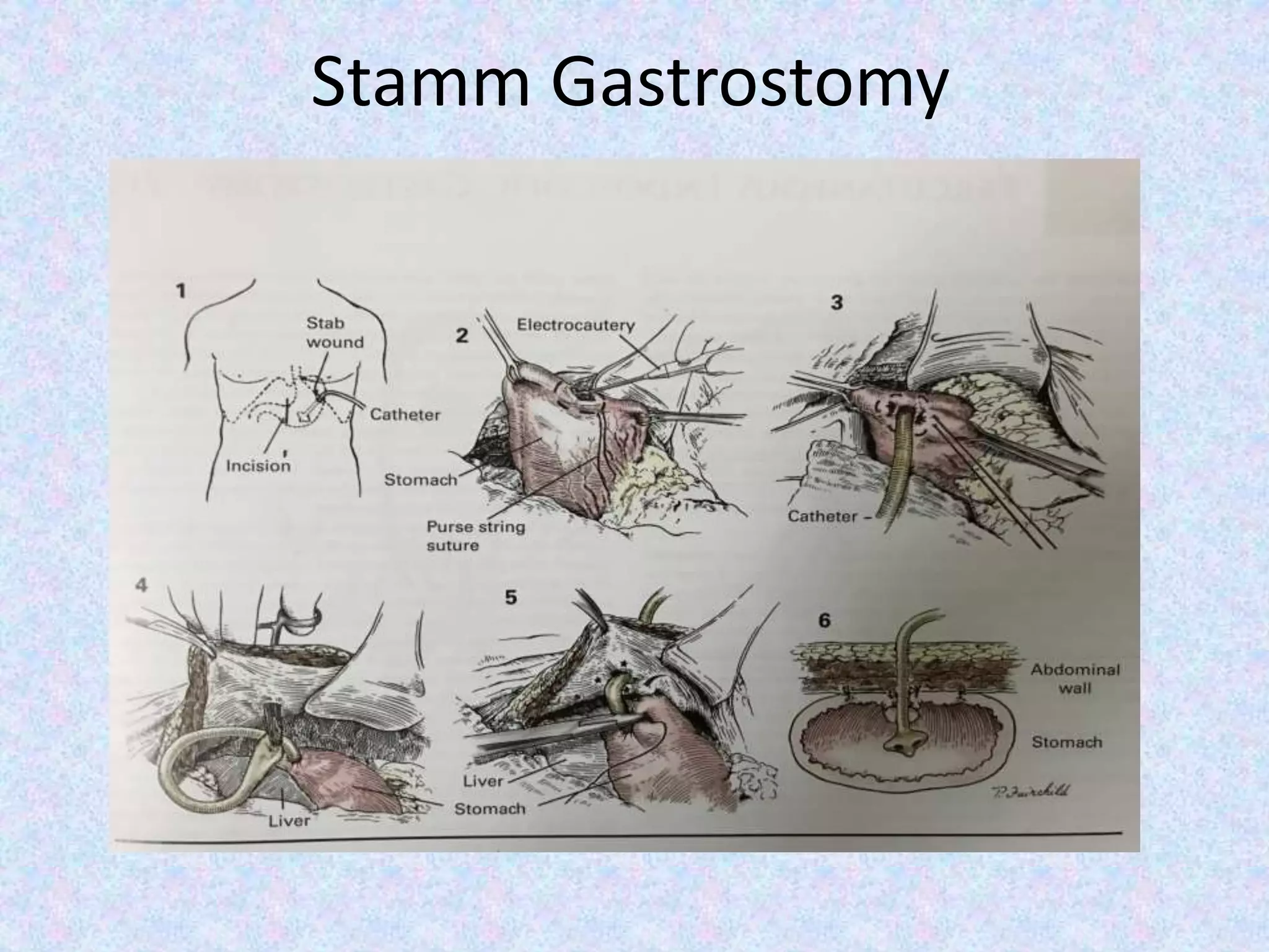 Seminar on stamm, janeway & PE gastrostomy | PPTX