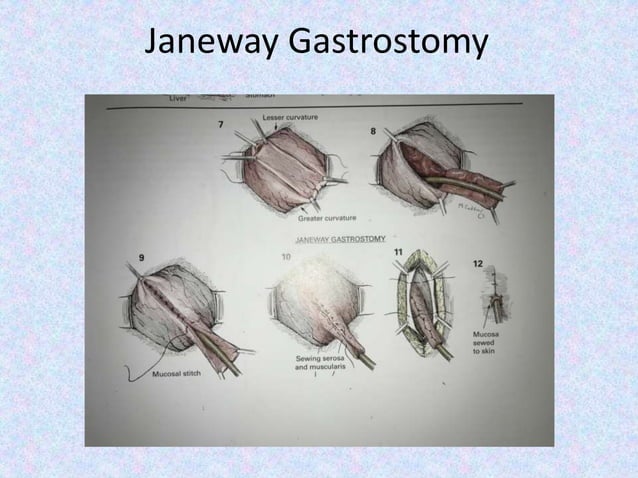 Seminar on stamm, janeway & PE gastrostomy | PPTX