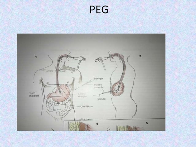 Seminar on stamm, janeway & PE gastrostomy | PPTX