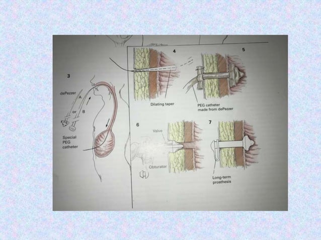 Seminar on stamm, janeway & PE gastrostomy | PPTX